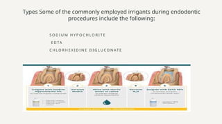 Comprehensive Overview of Intracanal Medicaments and Irrigants in ...