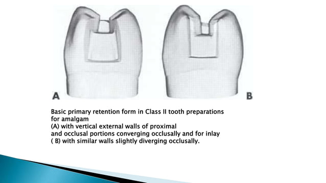 Fundamentals in tooth preparation (conservative dentistry)