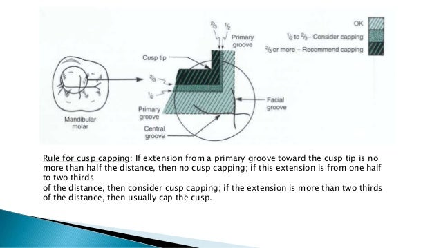 Fundamentals In Tooth Preparation Conservative Dentistry