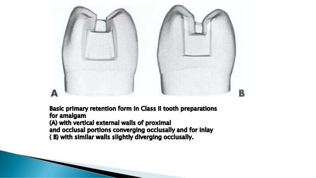 Fundamentals in tooth preparation (conservative dentistry)
