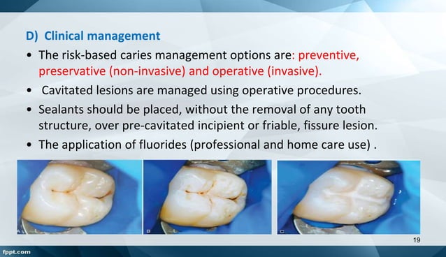 Caries Management System | PPTX
