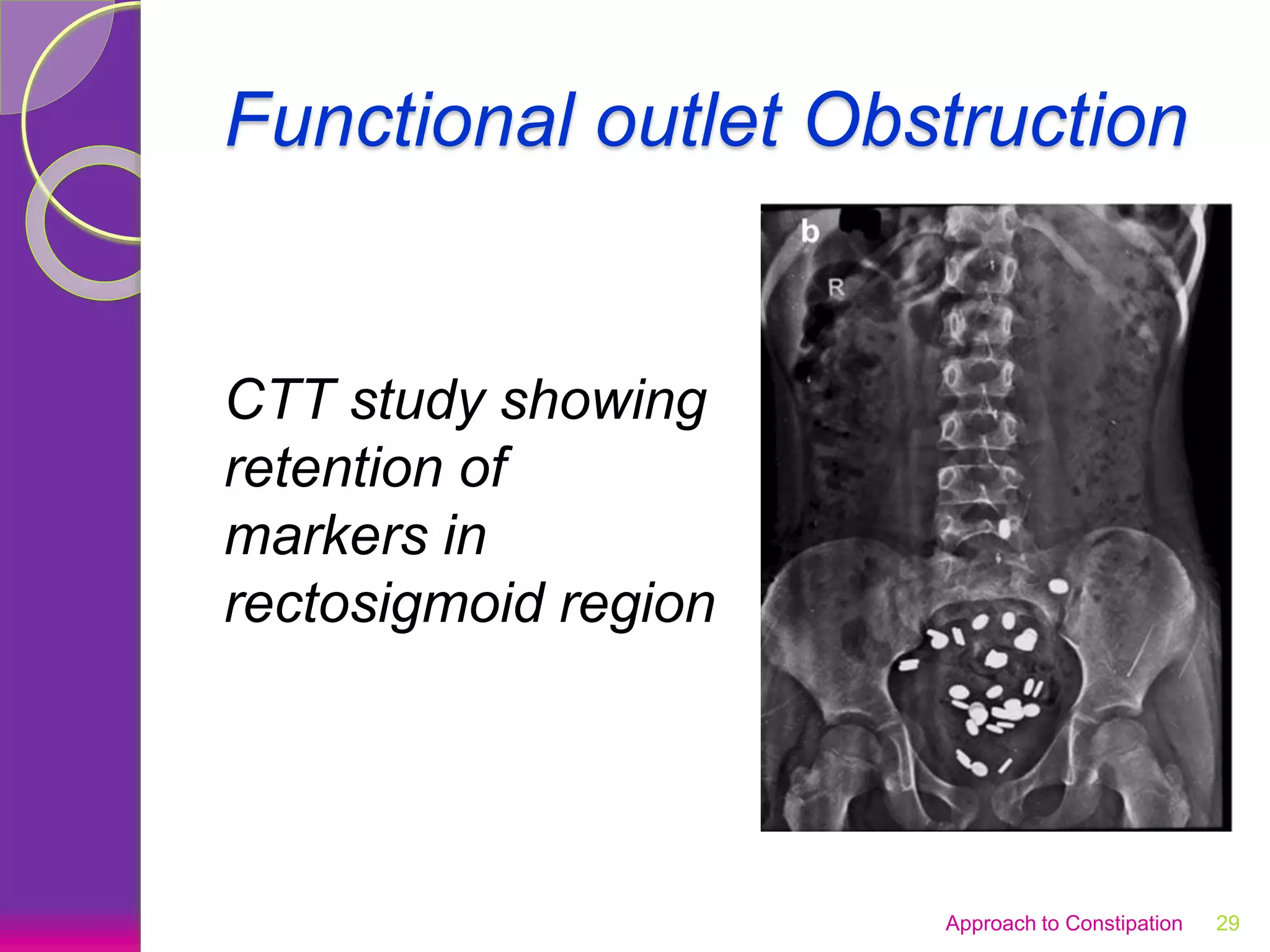 Approach to a child with Constipation | PPTX