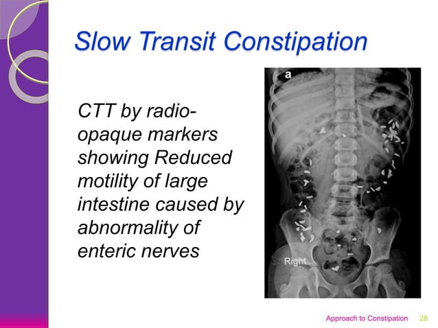 Approach to a child with Constipation | PPTX | Digestive Disorders ...