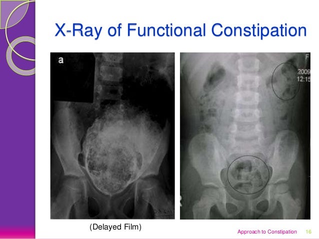 Approach to a child with Constipation