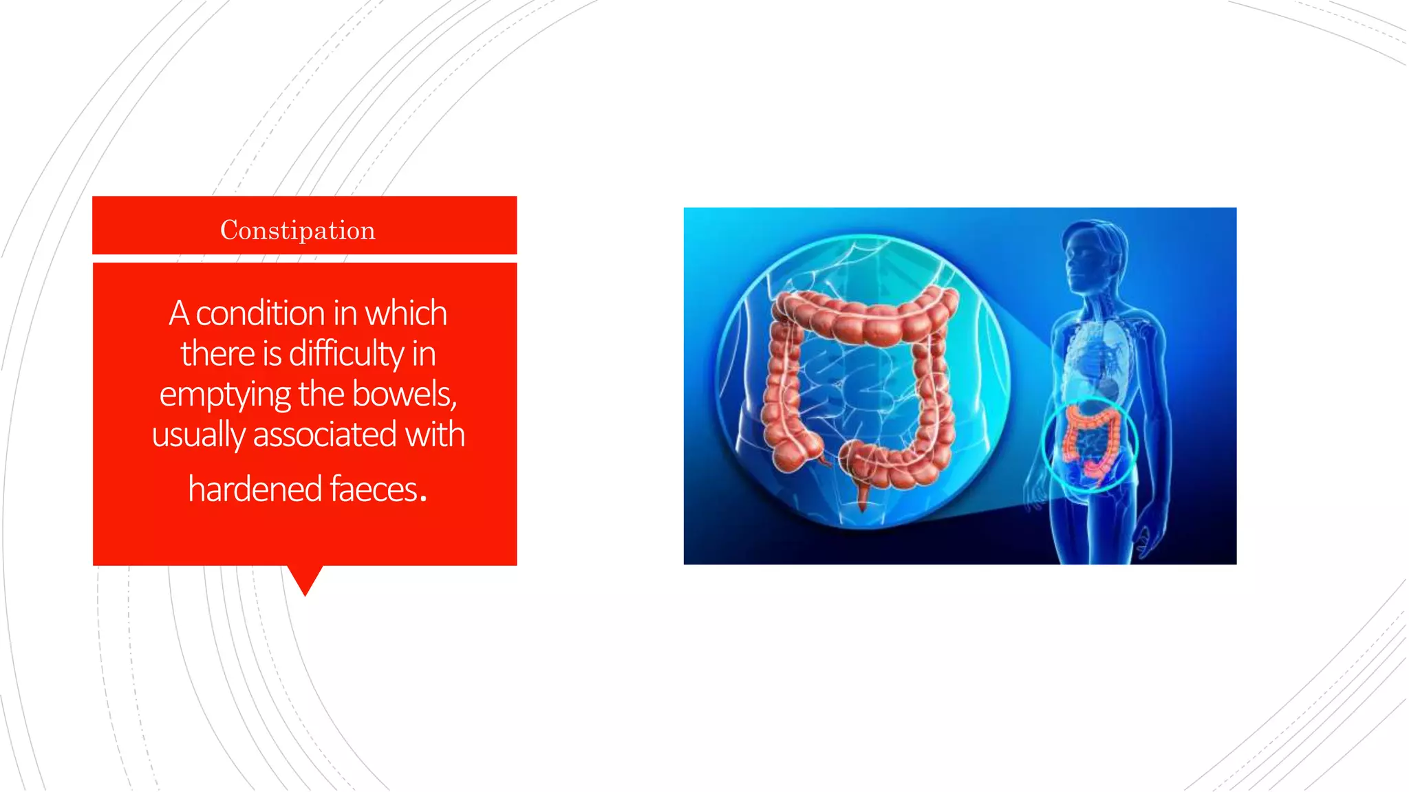 Constipation (OTC medication) | PPTX