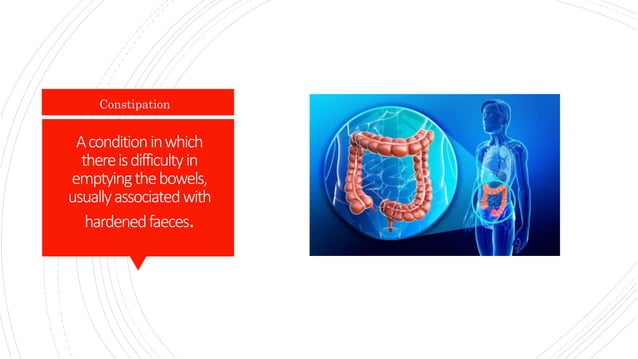 Constipation (OTC medication) | PPT