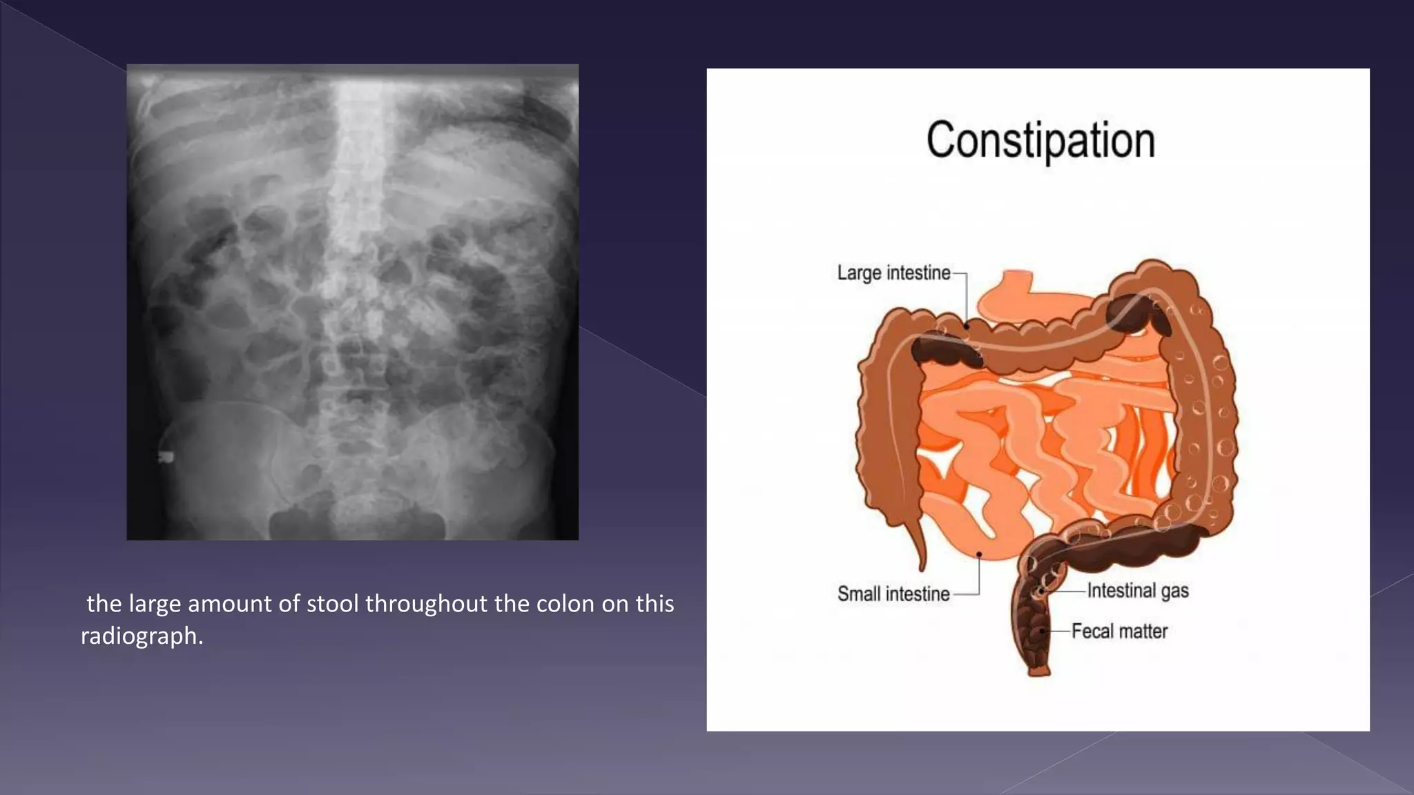Constipation | PDF