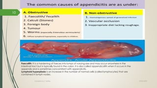 Constipation and appendicitis | PDF