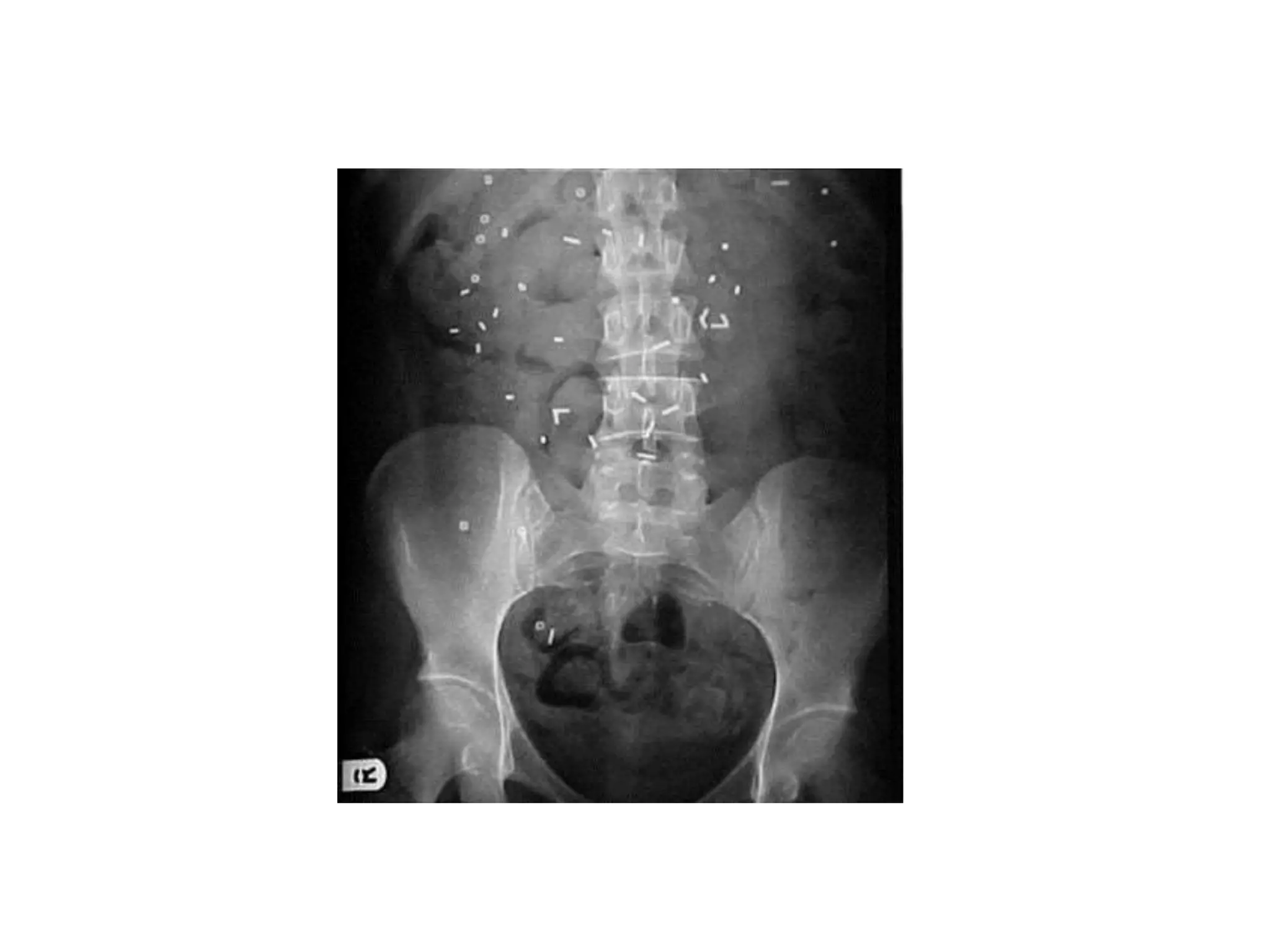 Constipation and Pelvic Floor Disorders.pptx