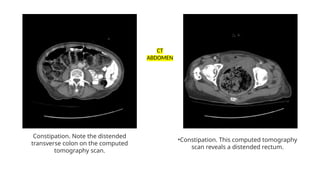 Constipation for undergraduate medical students.pptx