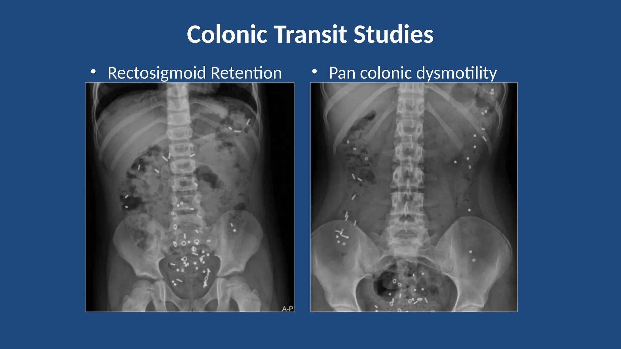 Constipation Lecture presentation xx.pptx