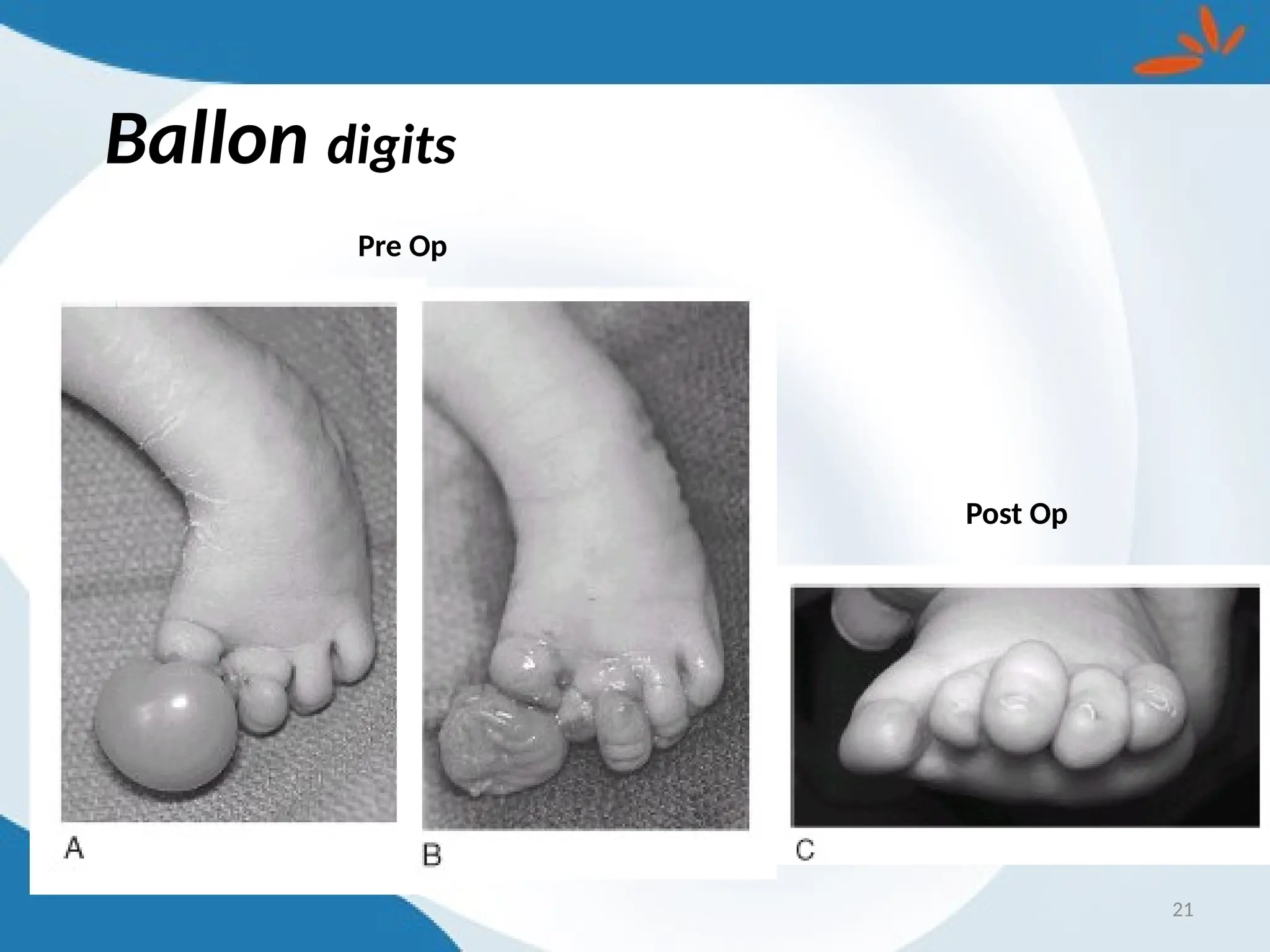 Constriction Ring Batjyjjd Syndrome.pptx