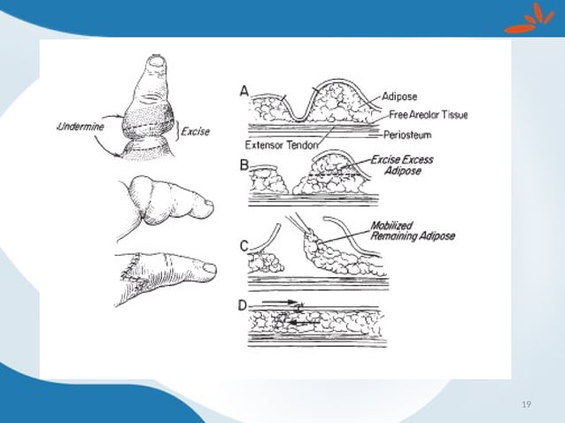 Constriction Ring Batjyjjd Syndrome.pptx
