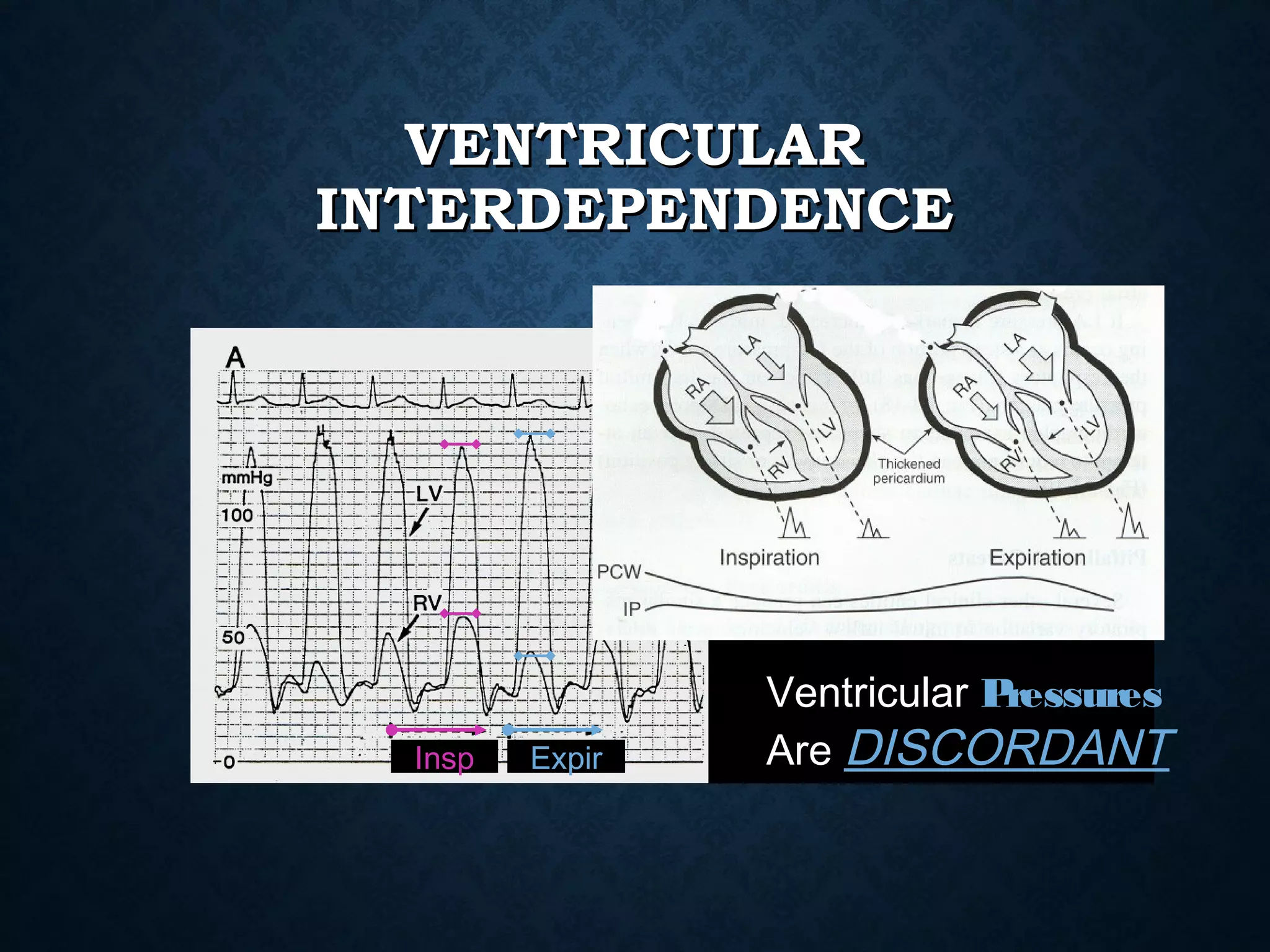 Constrictive pericarditis | PPT