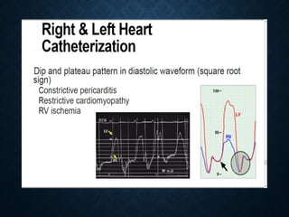 Constrictive Pericarditis Square Root Sign