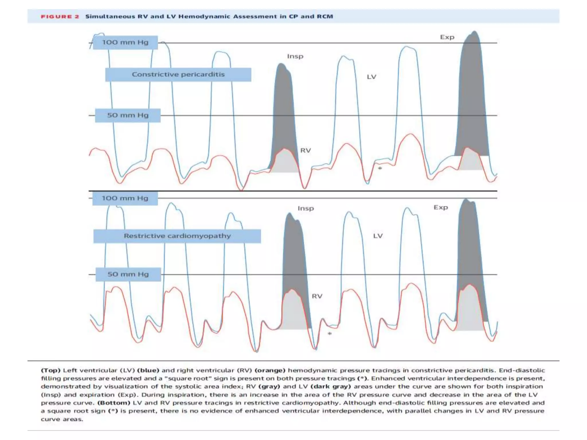 Constrictive pericarditis pathophysiology | PPTX