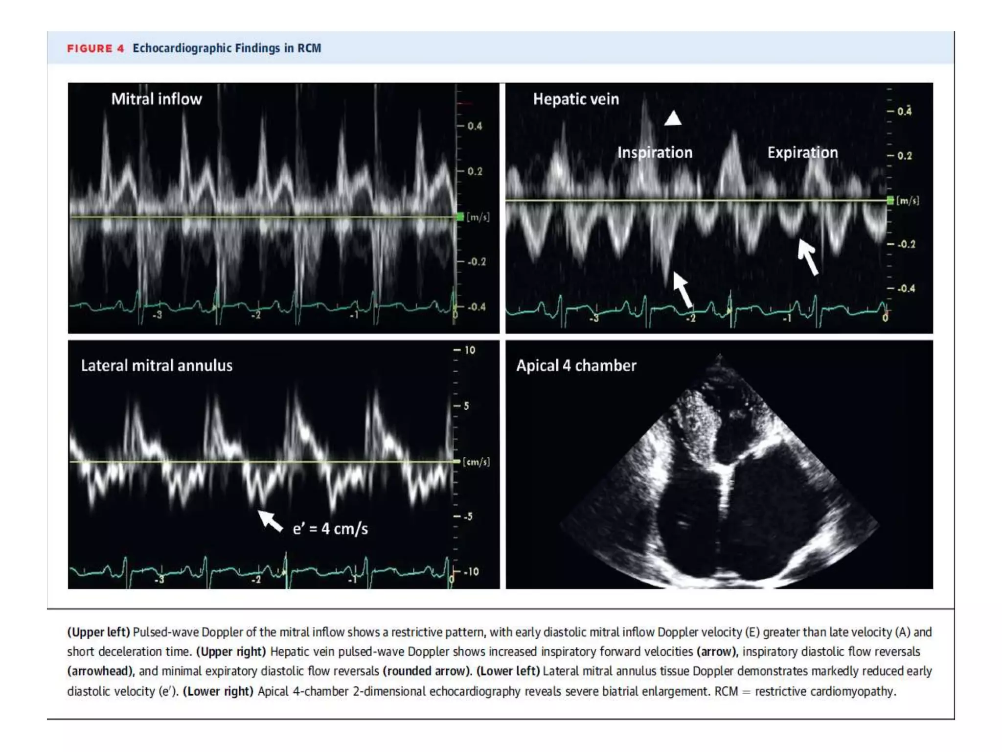 Constrictive pericarditis pathophysiology | PPTX