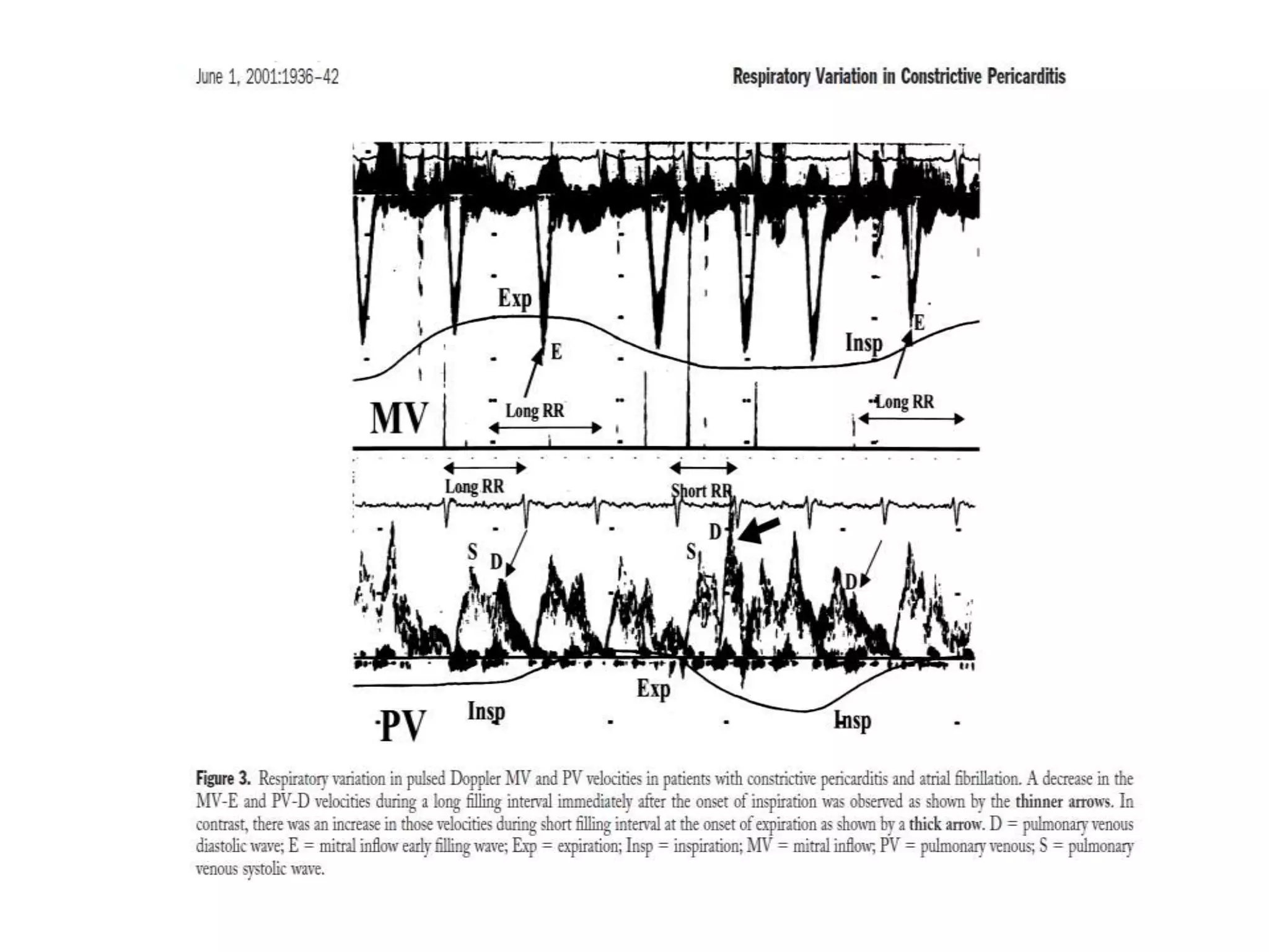 Constrictive pericarditis pathophysiology | PPTX