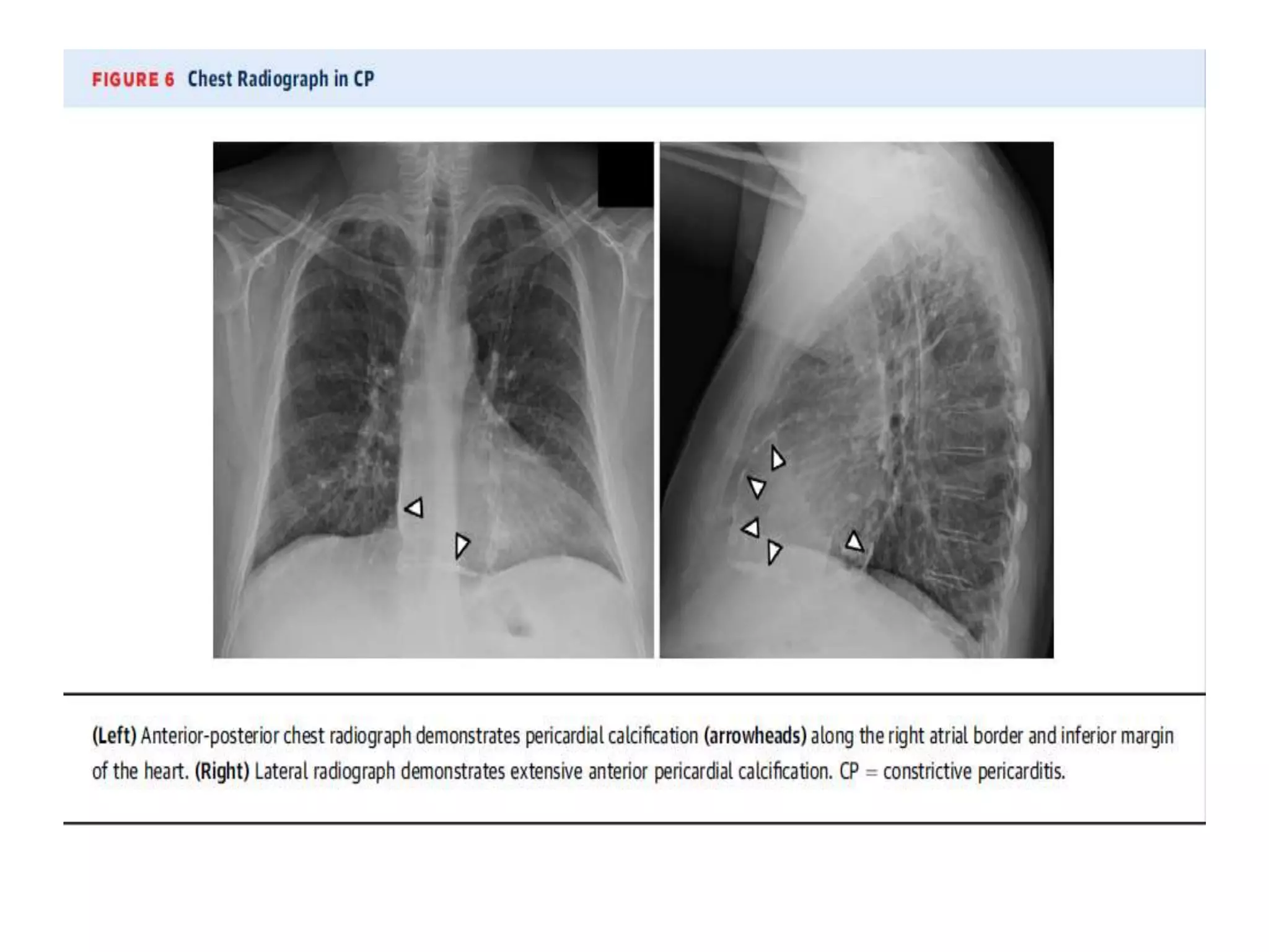 Constrictive pericarditis pathophysiology | PPTX