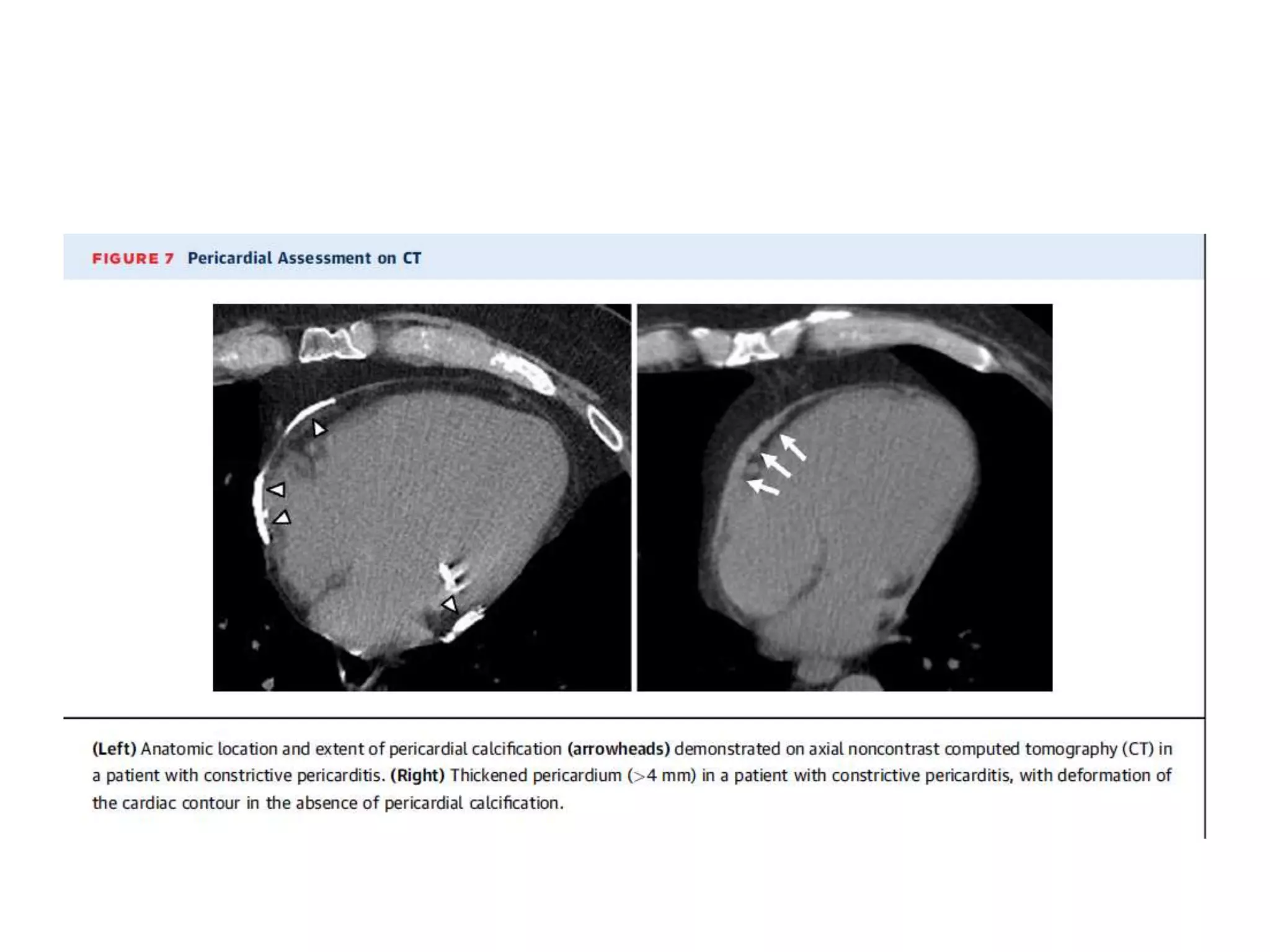 Constrictive pericarditis pathophysiology | PPTX