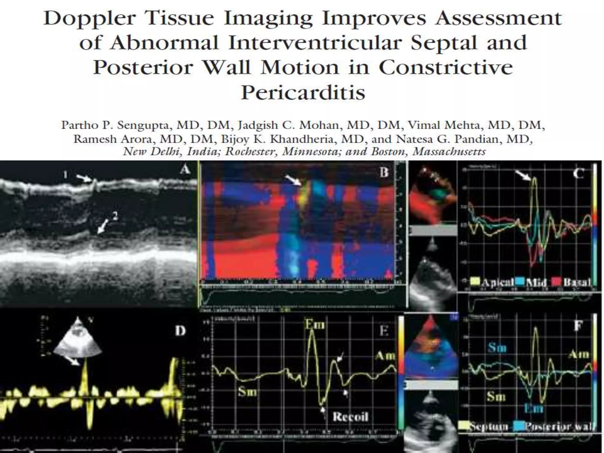 Constrictive pericarditis pathophysiology | PPTX