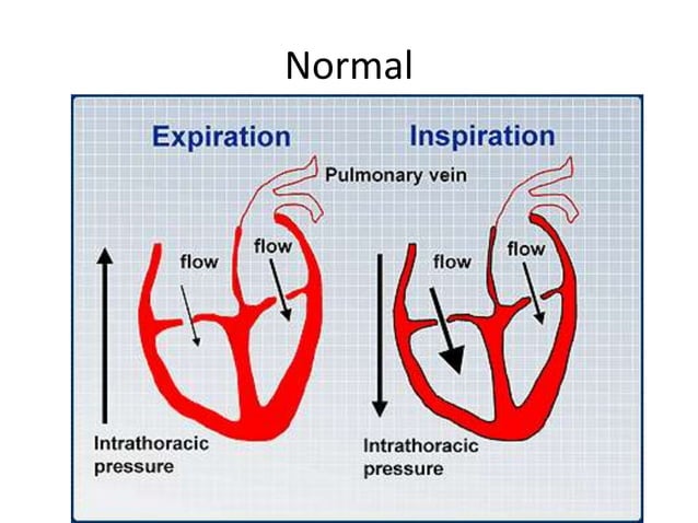 Constrictive pericarditis pathophysiology | PPTX