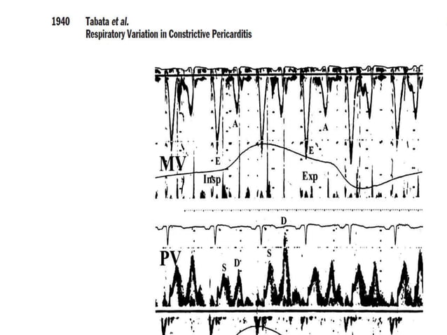 Constrictive pericarditis pathophysiology | PPTX