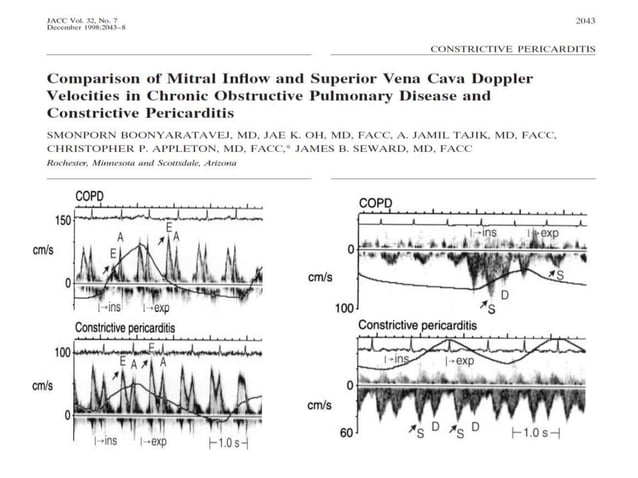 Constrictive pericarditis pathophysiology | PPTX