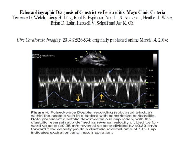 Constrictive pericarditis pathophysiology | PPTX