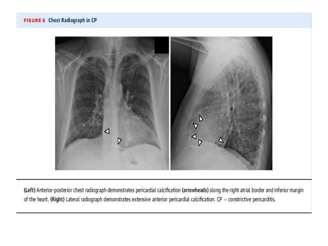 Constrictive pericarditis pathophysiology | PPTX