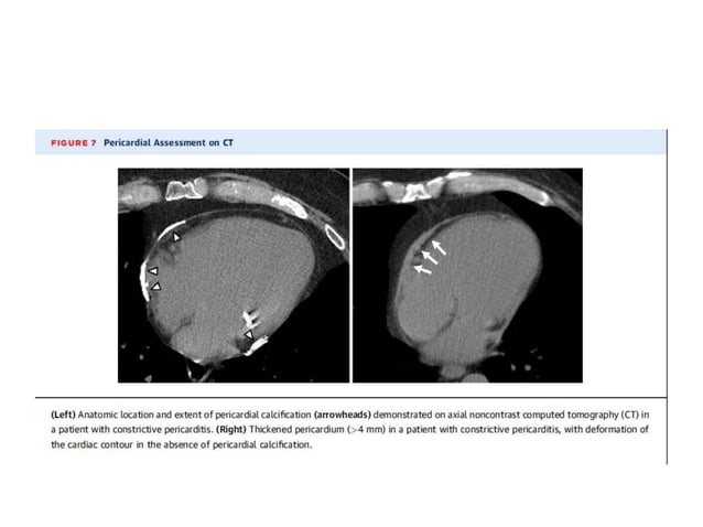Constrictive pericarditis pathophysiology | PPTX