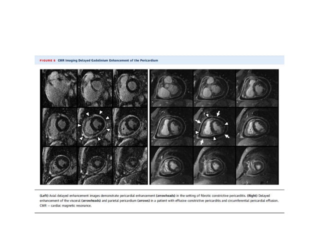 Constrictive pericarditis pathophysiology | PPTX