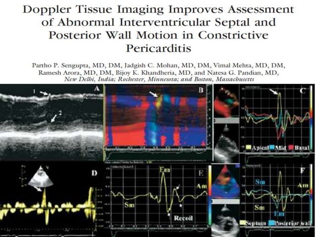 Constrictive pericarditis pathophysiology | PPTX
