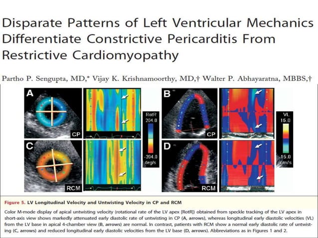 Constrictive pericarditis pathophysiology | PPTX