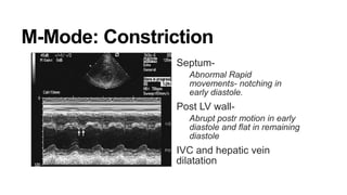 Constrictive pericarditis | PPTX