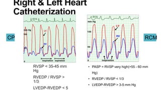 Constrictive pericarditis | PPT