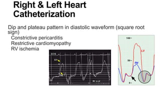 Constrictive Pericarditis Square Root Sign