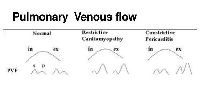 Constrictive pericarditis