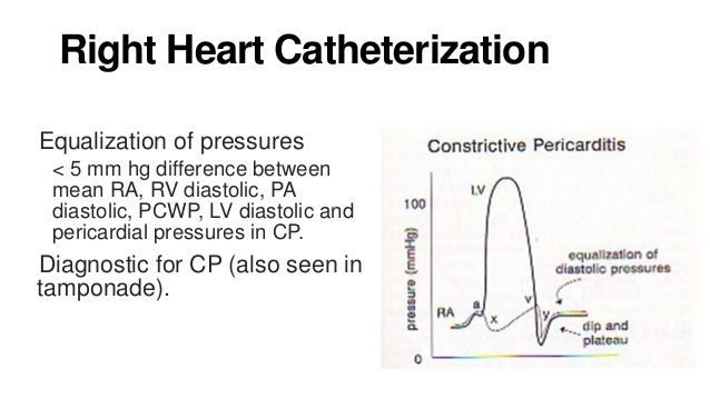 Constrictive pericarditis