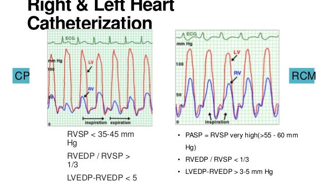 Constrictive pericarditis