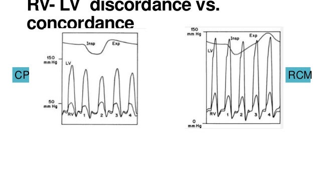 Constrictive pericarditis