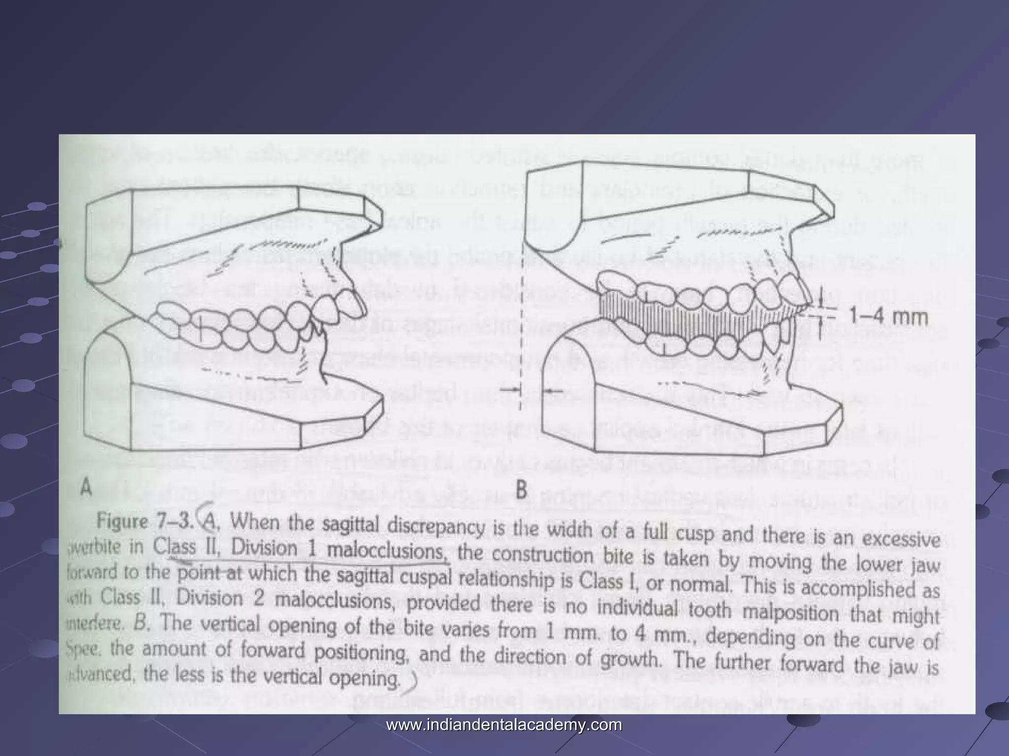 Construction of bite for various functional orthodontic appliances | PPT