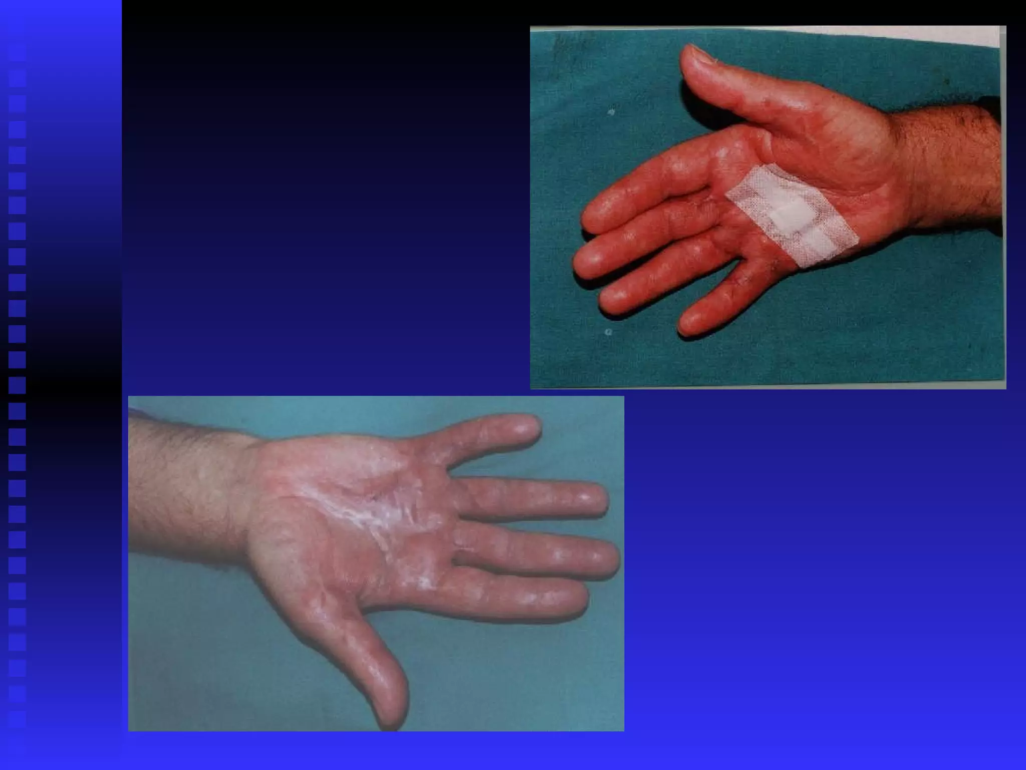 Hand Therapy - Continuous Passive Motion | PPT