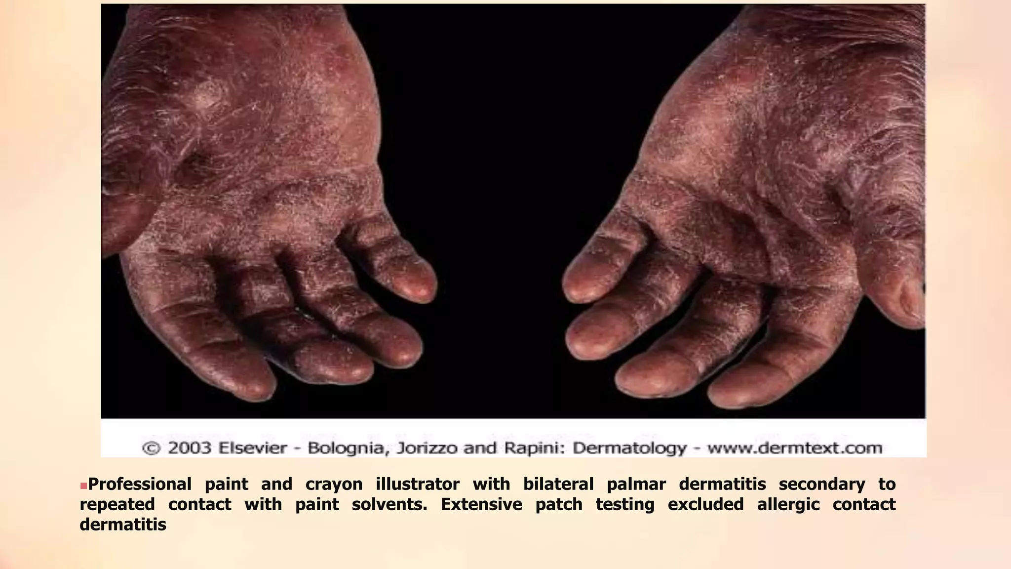 Contact dermatitis | PPTX