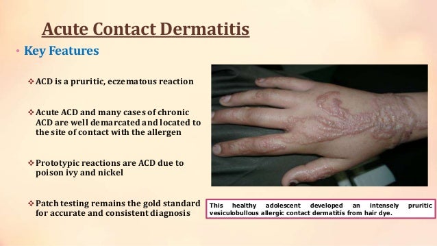 Contact dermatitis