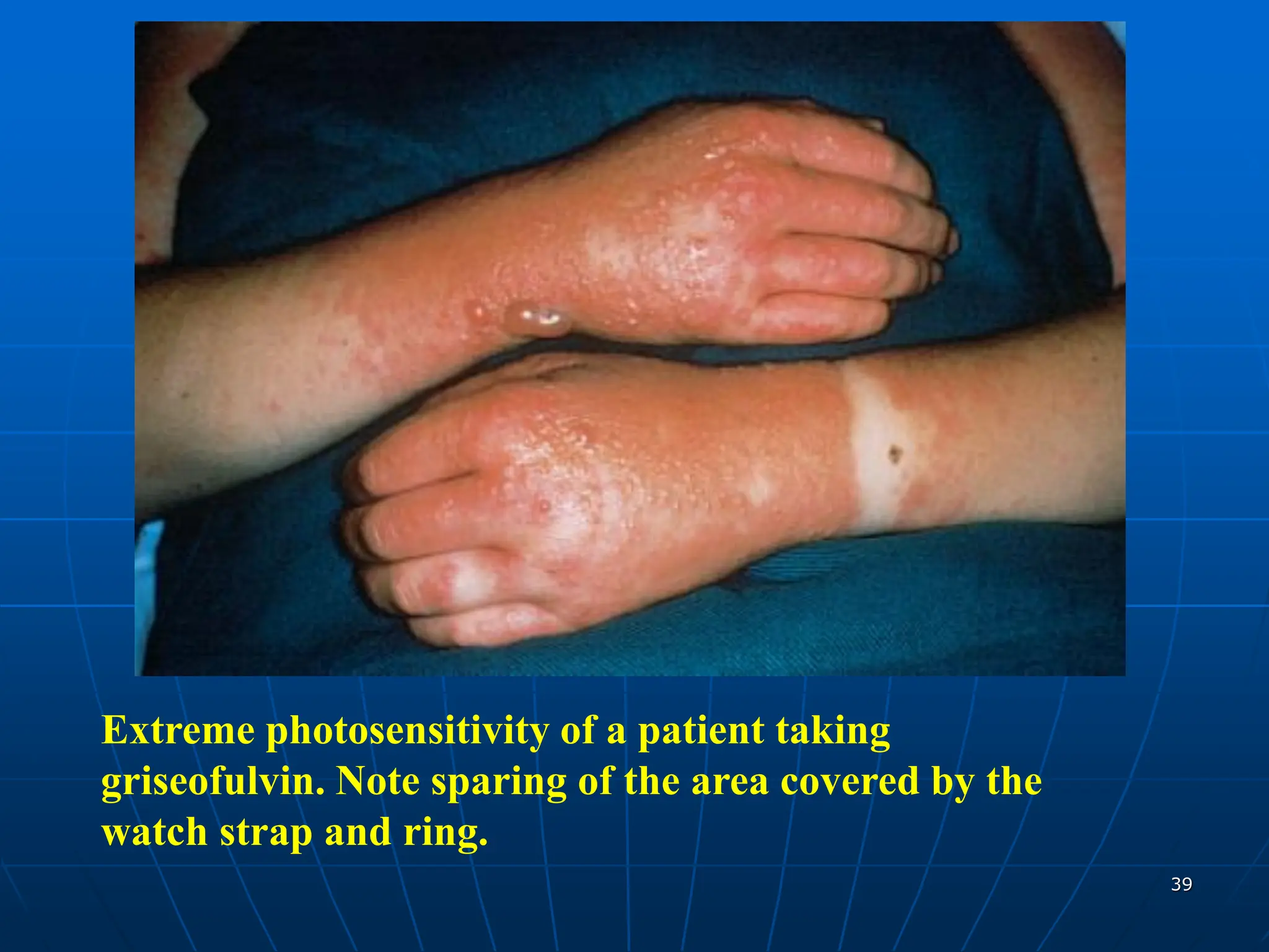 contact dermatitis in adults and children.ppt