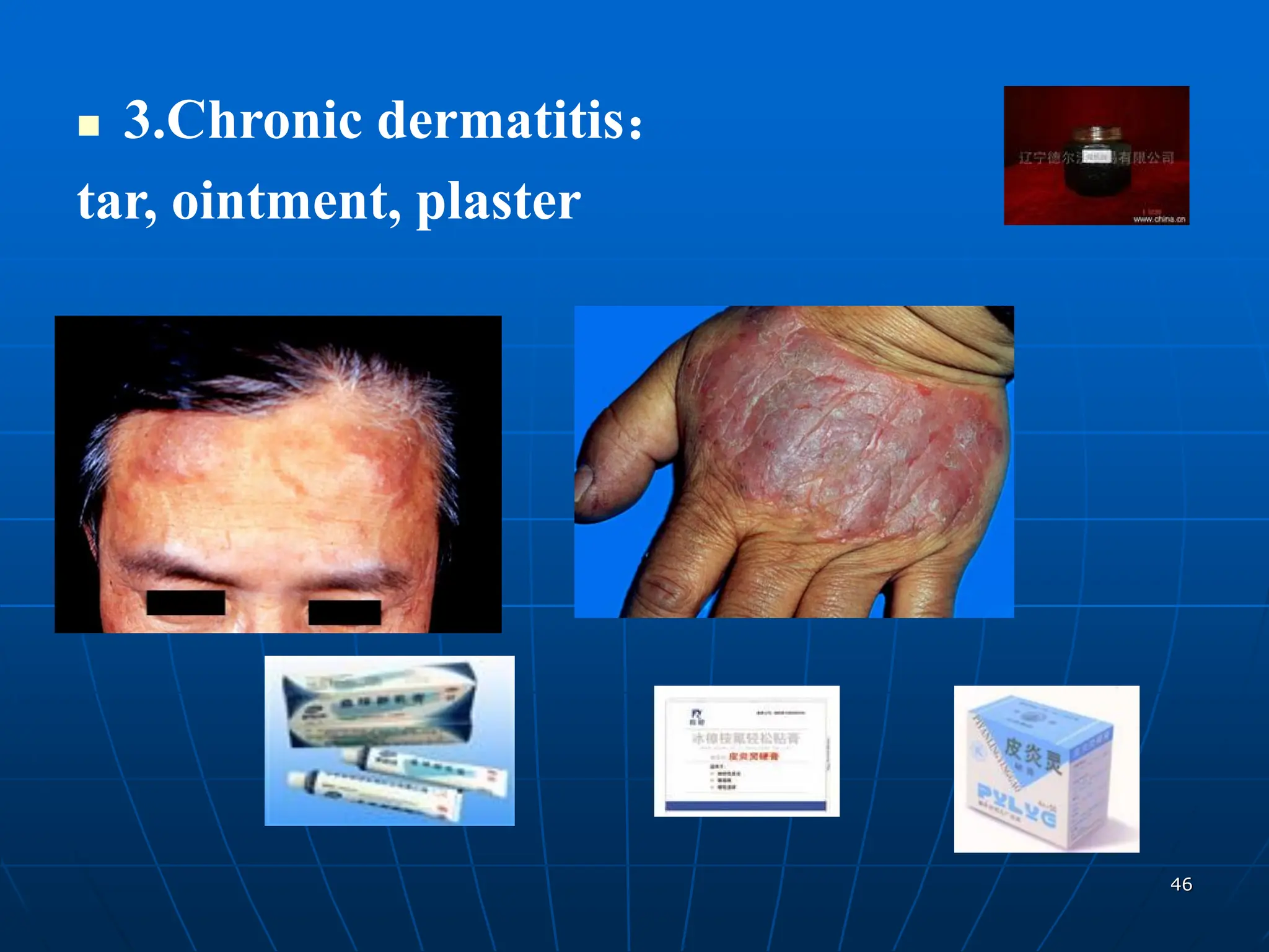 contact dermatitis in adults and children.ppt