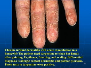 contact dermatitis in adults and children.ppt