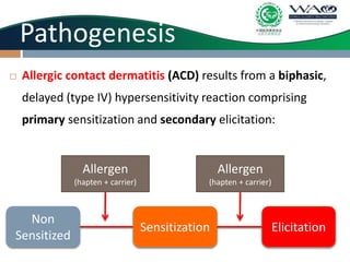 Irritant Contact Dermatitis Pathophysiology