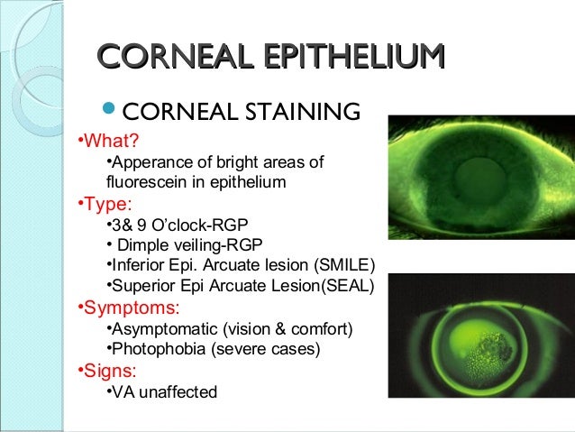 Contact lens complication